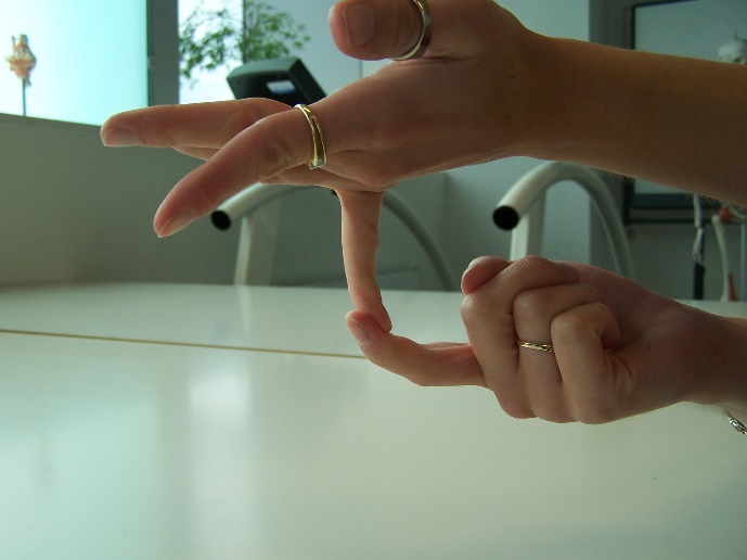 What is Hypermobile Ehlers-Danlos Syndrome? - Singing Dragon and ...